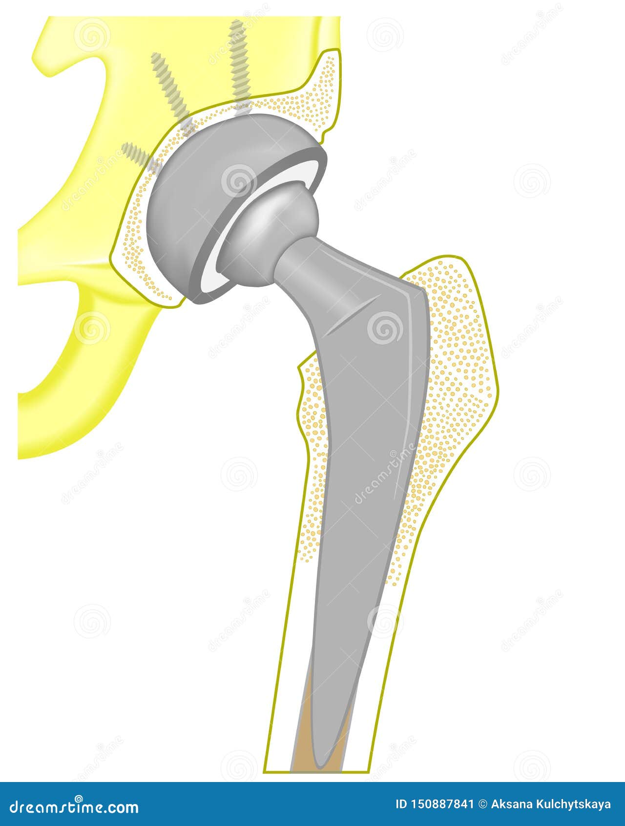 Pelvis and Hip Joint Problem_Total Hip Replacement-24 Stock Vector ...