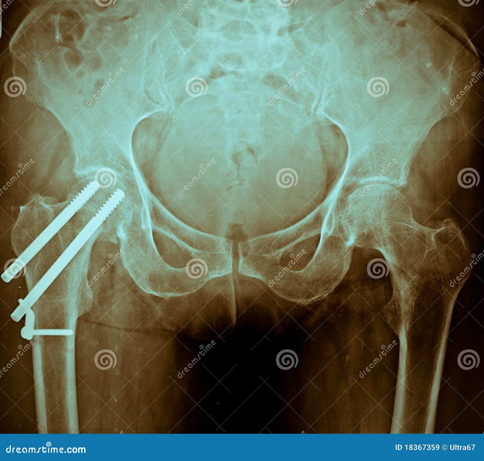 Pelvis X Ray stock image. Image of clinic, pain, surgery - 18367359