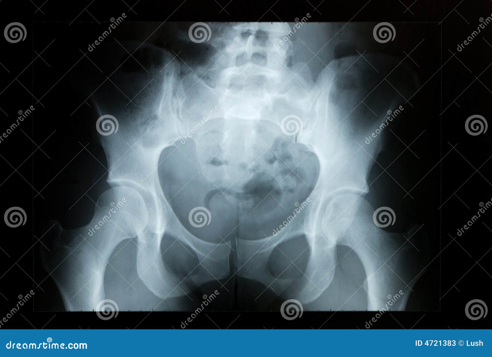 Pelvis X-ray stock image. Image of diagnostic, back, health - 4721383