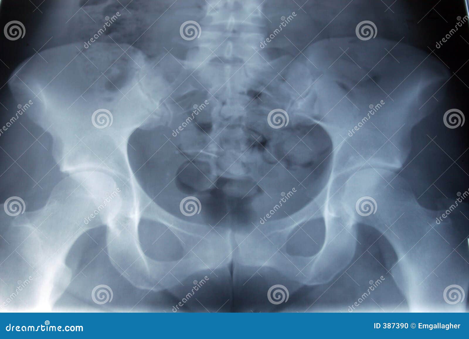 Pelvis xray stock photo. Image of medicine, pelvis, bones - 387390