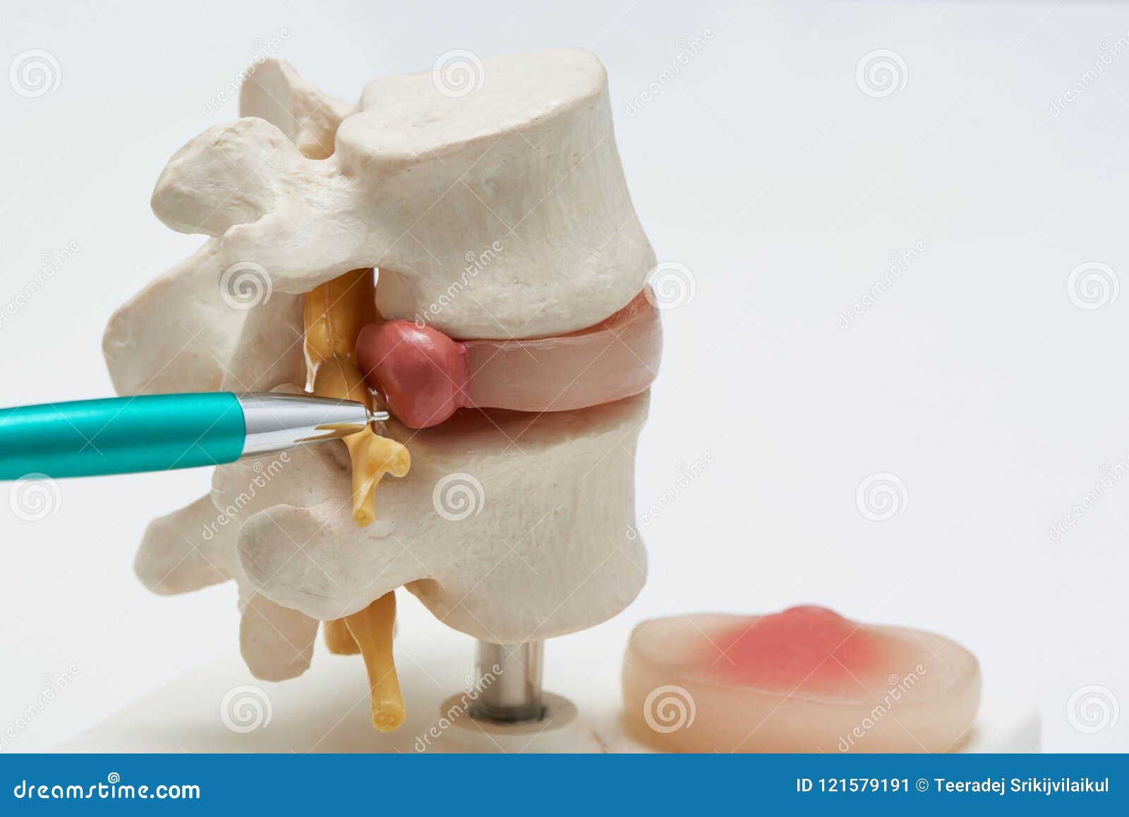 A Pen Pointing at Herniated Lumbar Disc Model Stock Image - Image of ...