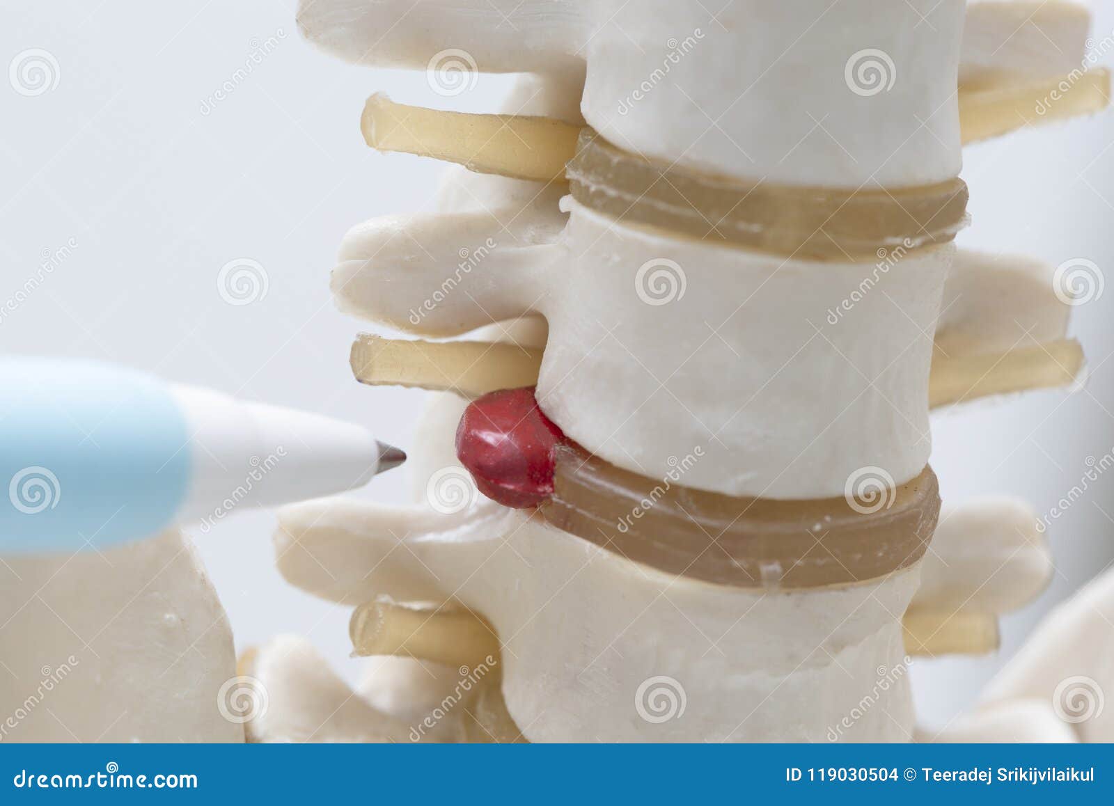 A Pen Pointing At Herniated Lumbar Disc Model Stock Photography ...
