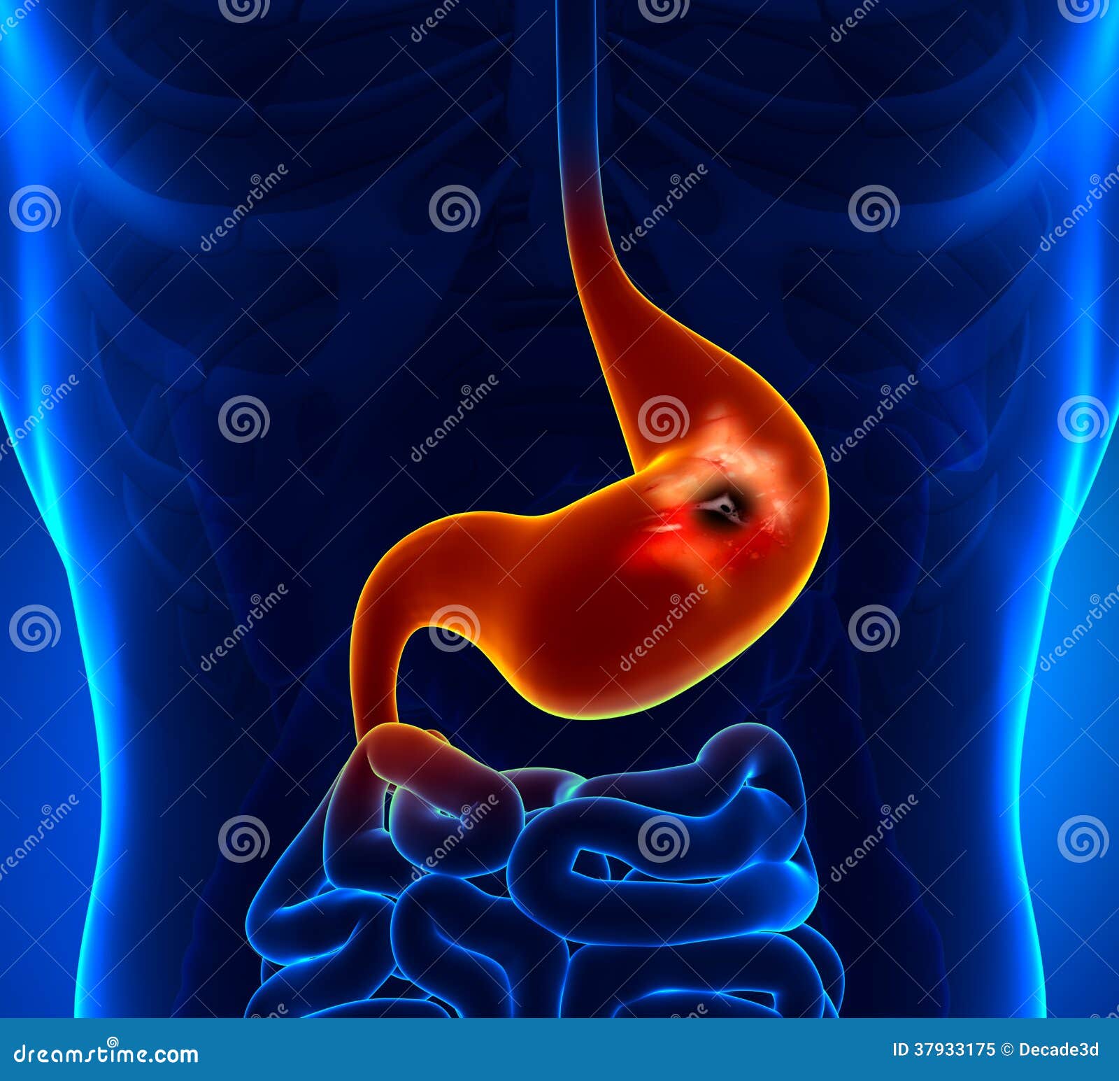 Peptic Ulcer stock illustration. Illustration of health - 37933175