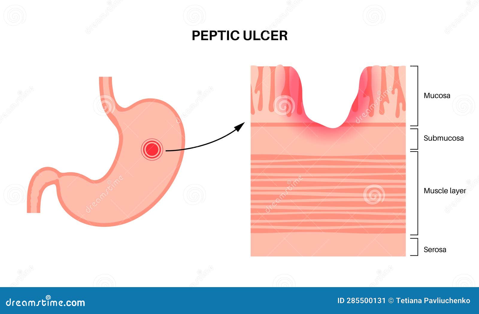 Peptic ulcer disease stock illustration. Illustration of anatomy ...