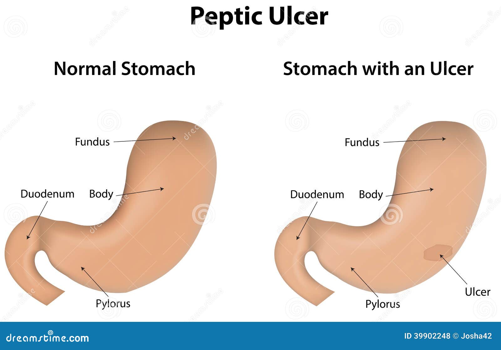 Peptic Ulcer stock vector. Illustration of stomach, peptic - 39902248