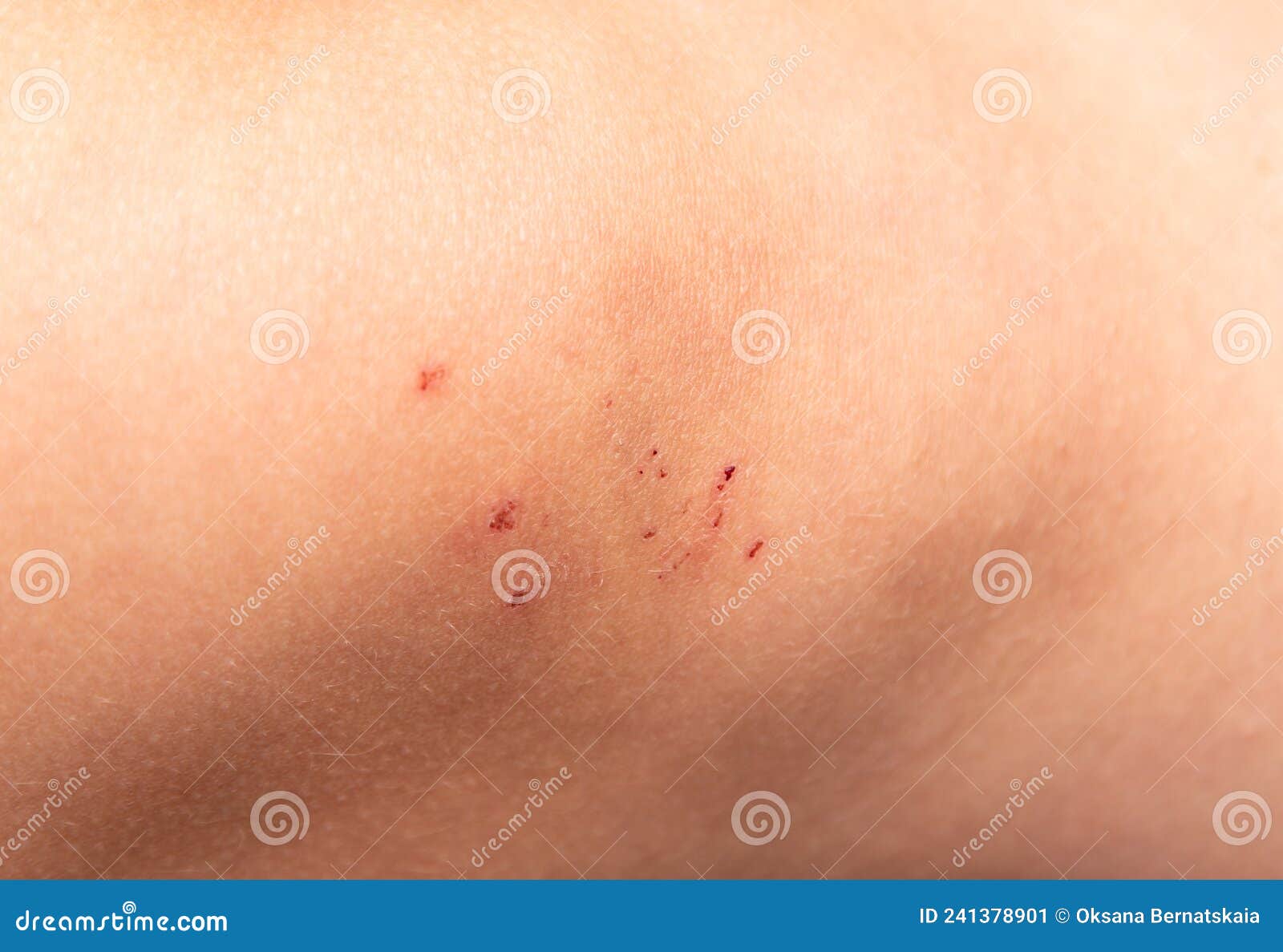 Pequenos Arranhões Na Pele Com Hematomas Imagem de Stock - Imagem de ...