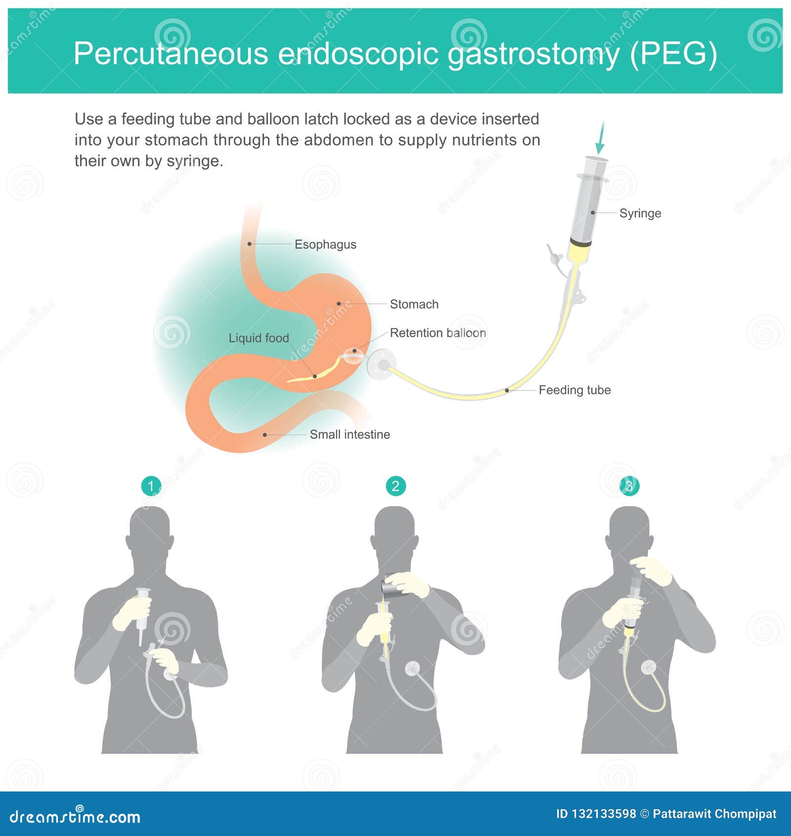Percutane Endoscopische Gastrostomypin Vector Illustratie ...