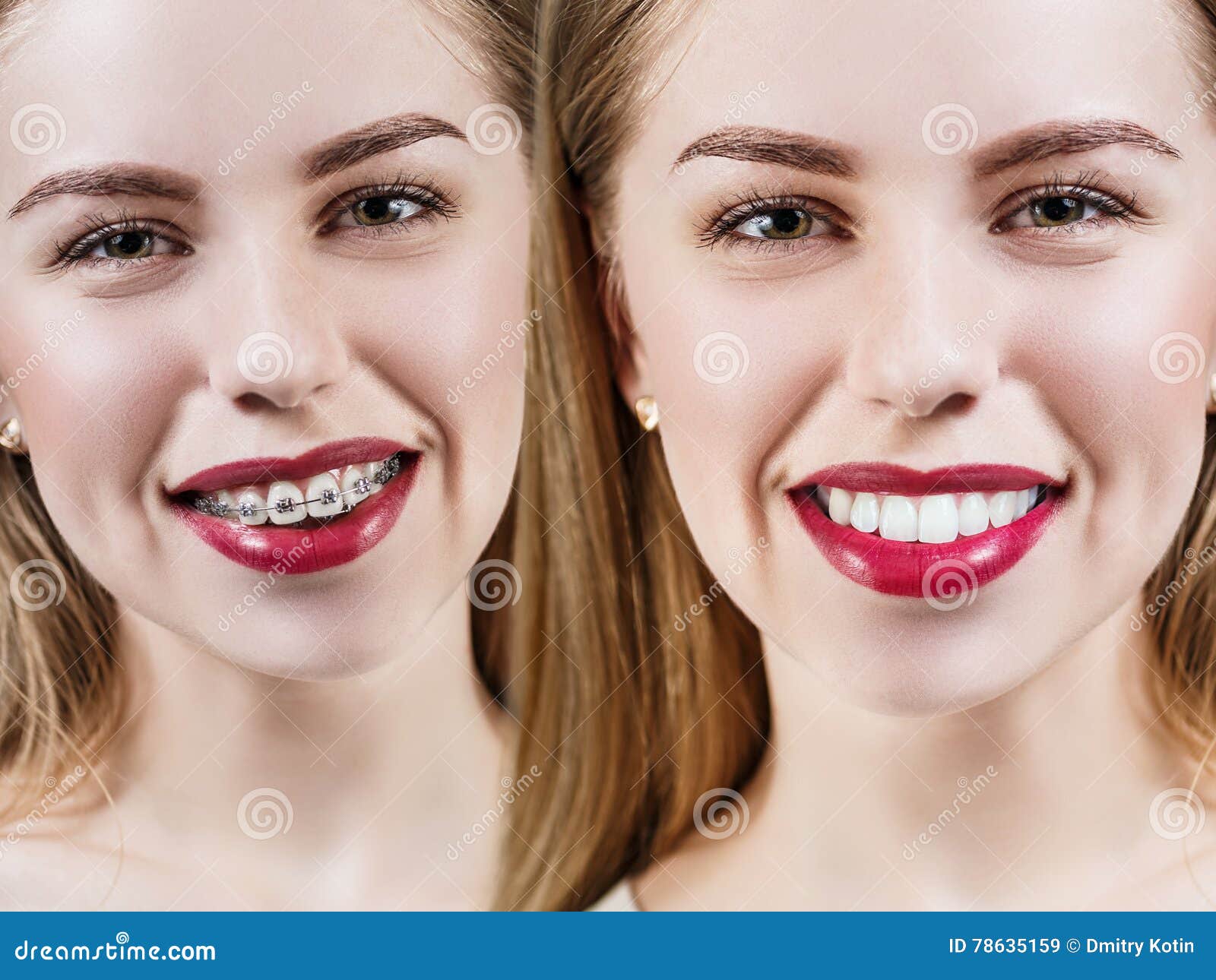 Perfect Teeth before and after Braces Stock Image - Image of lips ...