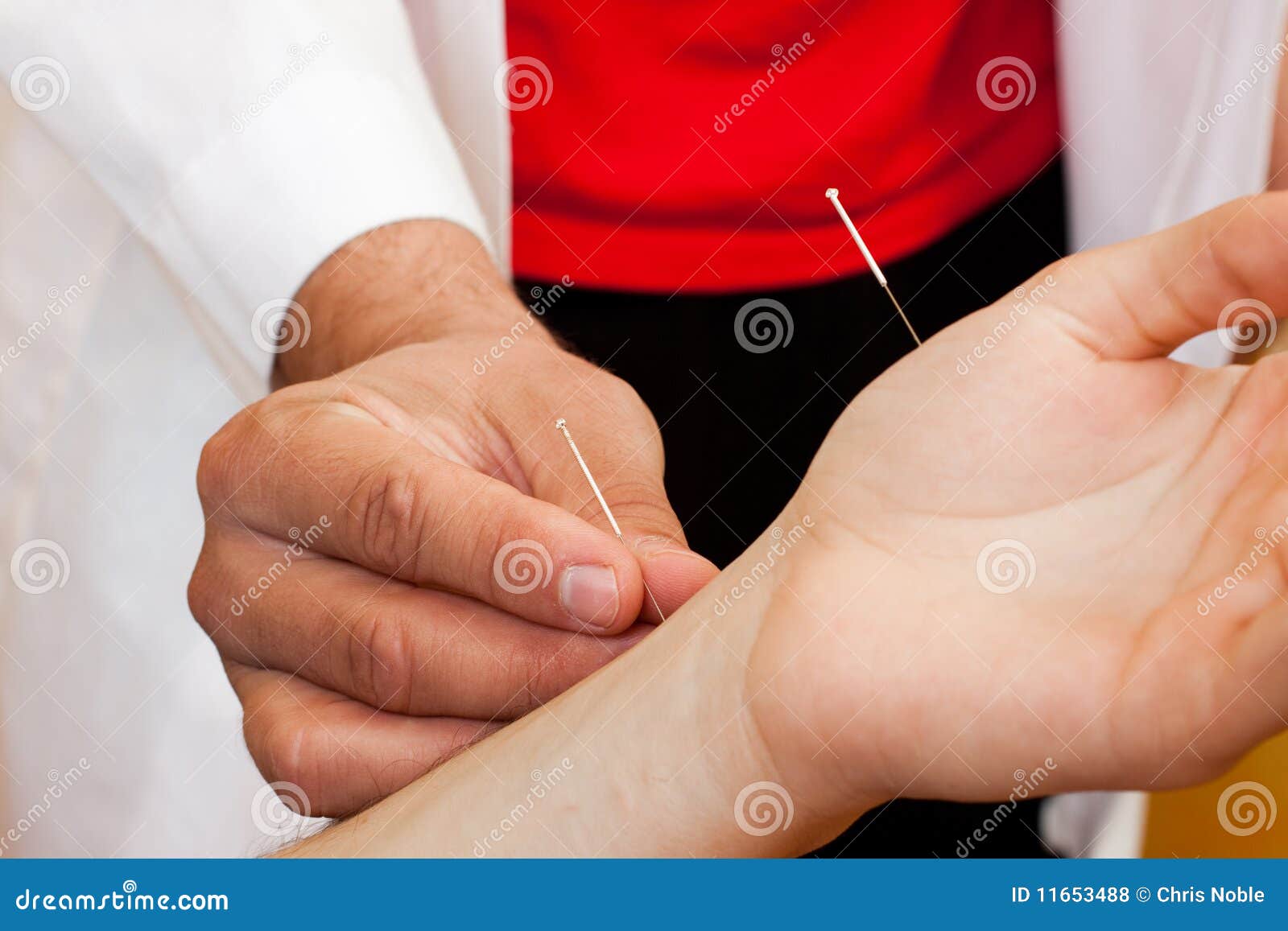 Performing acupuncture stock photo. Image of caring, healthy - 11653488