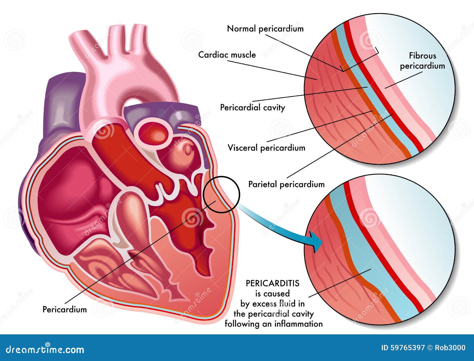 Pericardite illustrazione vettoriale. Illustrazione di pericardio ...