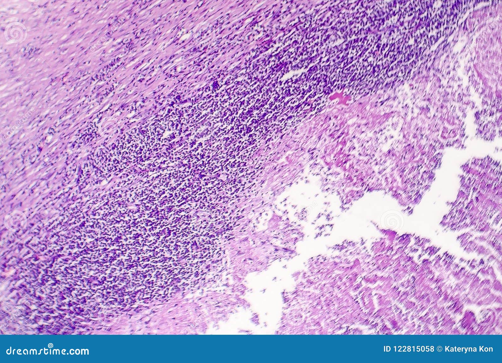 Pericarditis, Light Micrograph, Photo Under Microscope Stock Photo ...
