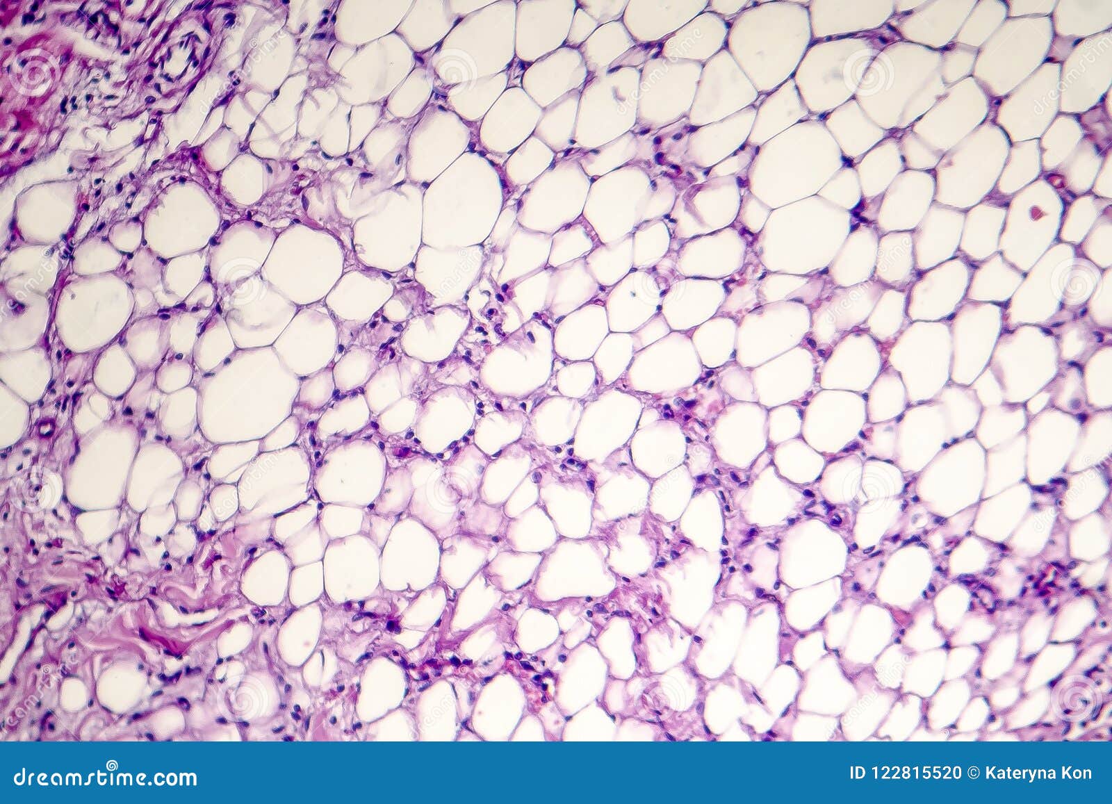 Pericarditis, Light Micrograph, Photo Under Microscope Stock Photo ...
