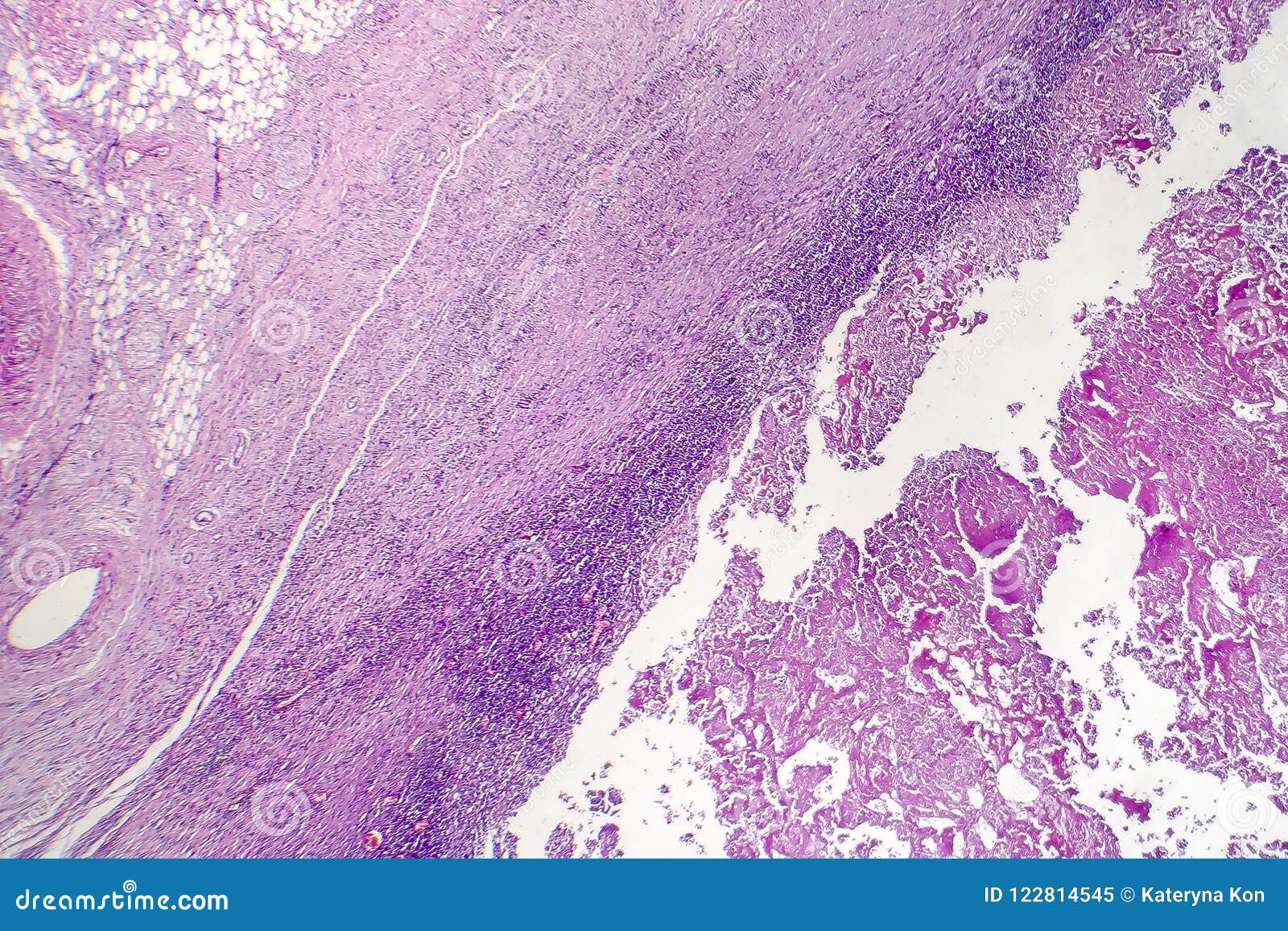 Pericarditis, Light Micrograph, Photo Under Microscope Stock Image ...