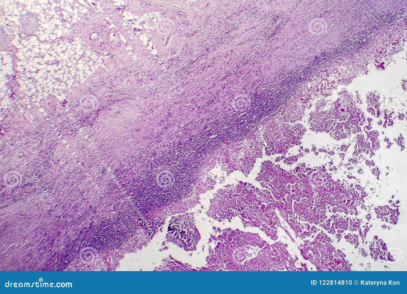 Pericarditis, Light Micrograph, Photo Under Microscope Royalty-Free ...