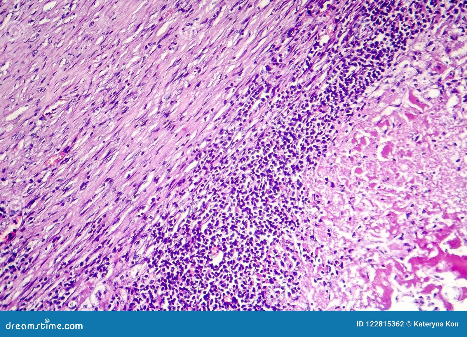 Pericarditis, Light Micrograph, Photo Under Microscope Stock Photo ...