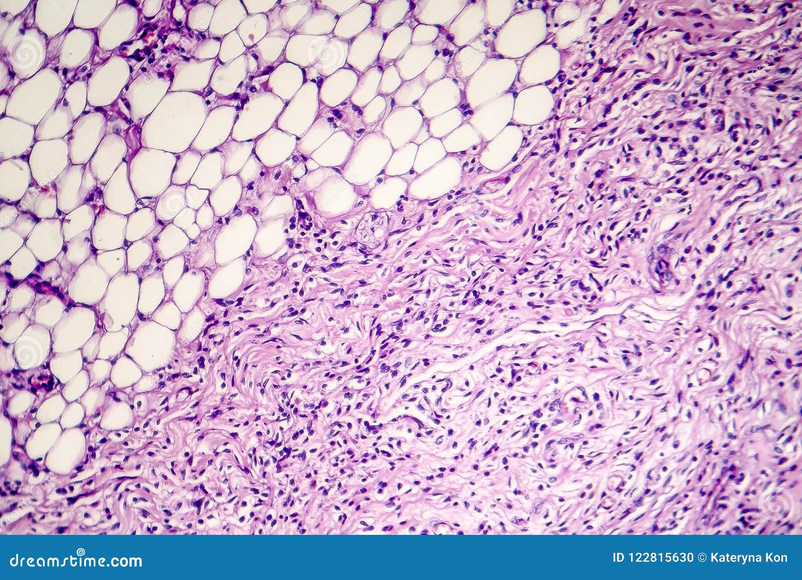 Pericarditis, Light Micrograph, Photo Under Microscope Stock Photo ...