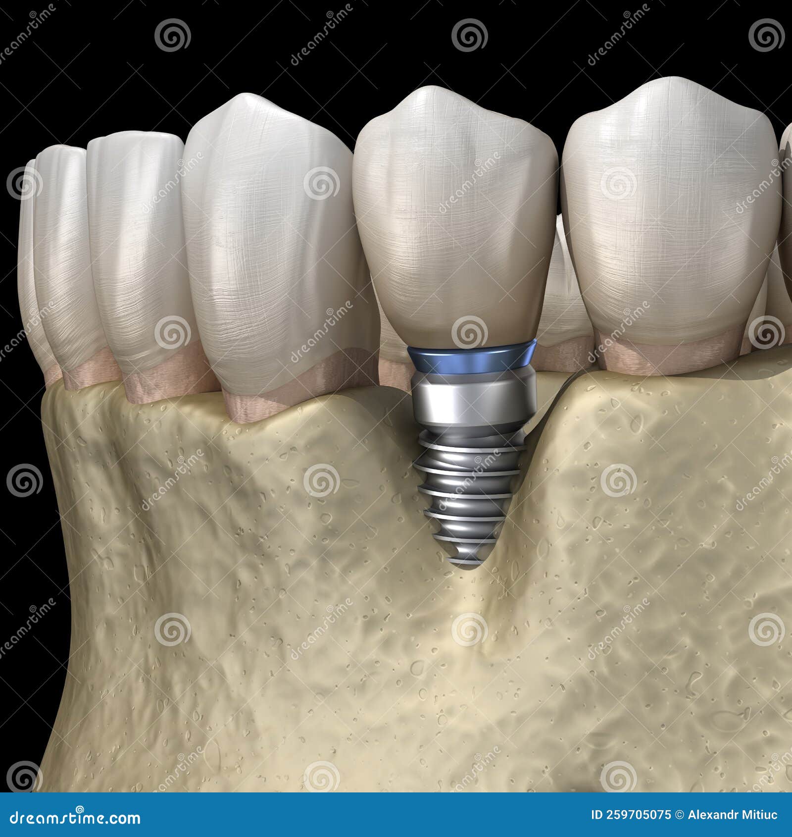 Periimplantitis with Visible Bone Reduction. Medically Accurate 3D ...