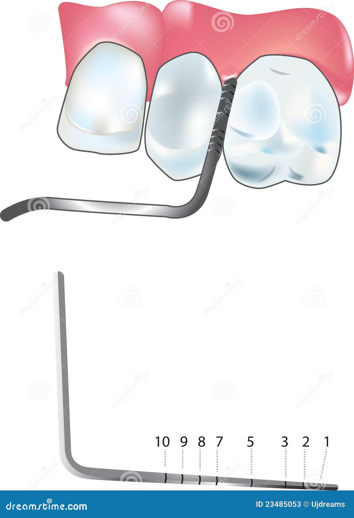 Periodontal probe stock vector. Illustration of surgery - 23485053