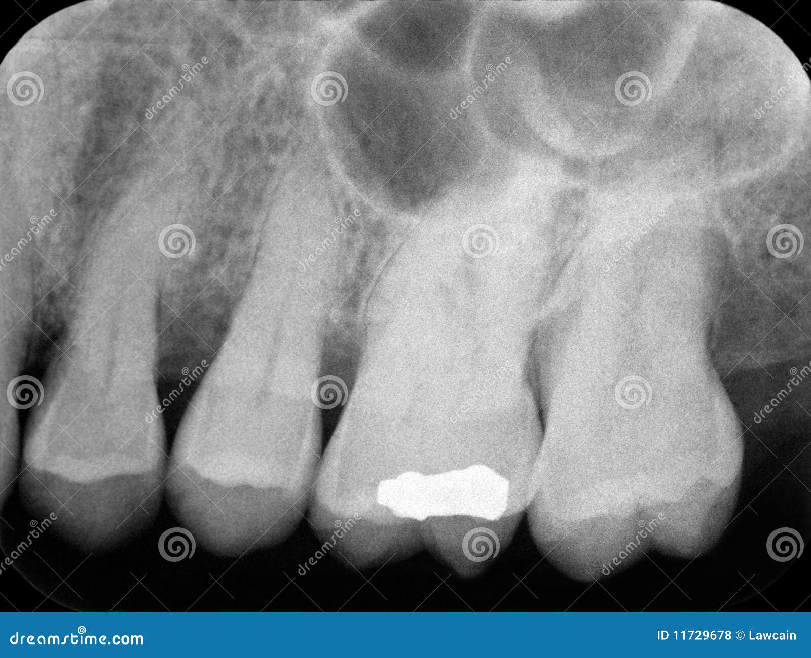 Gingival Abscess Inscription Title On Hygienic Dental Background Stock ...
