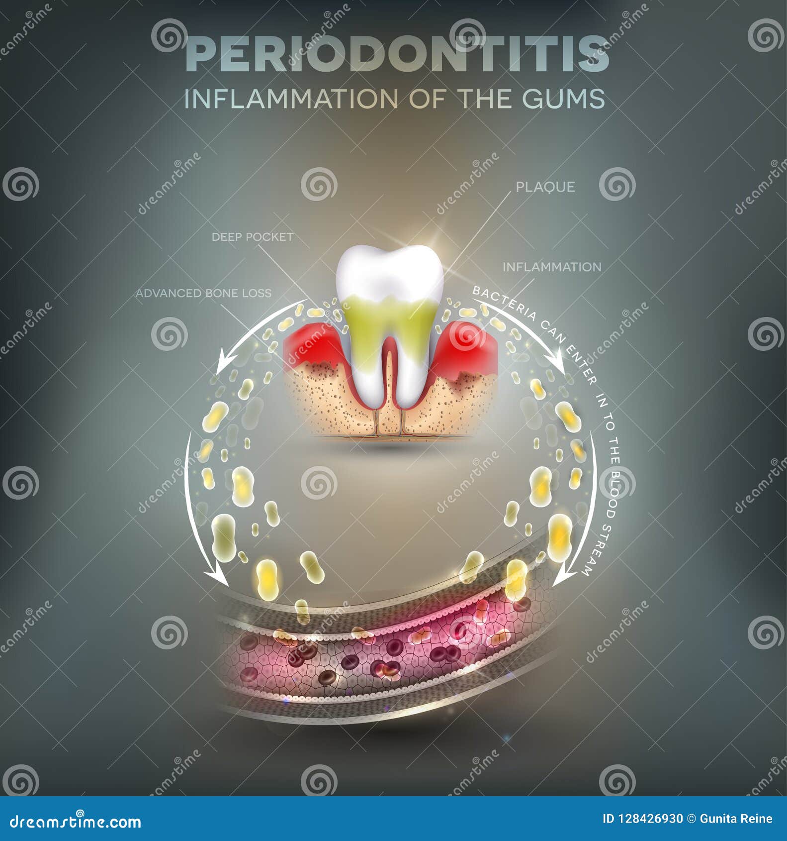 Periodontitis иллюстрация вектора. иллюстрации насчитывающей здоровье ...