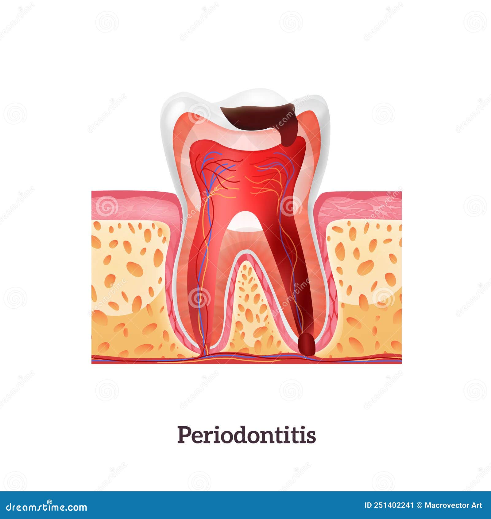 Periodontitis Realistic Illustration Stock Vector - Illustration of ...