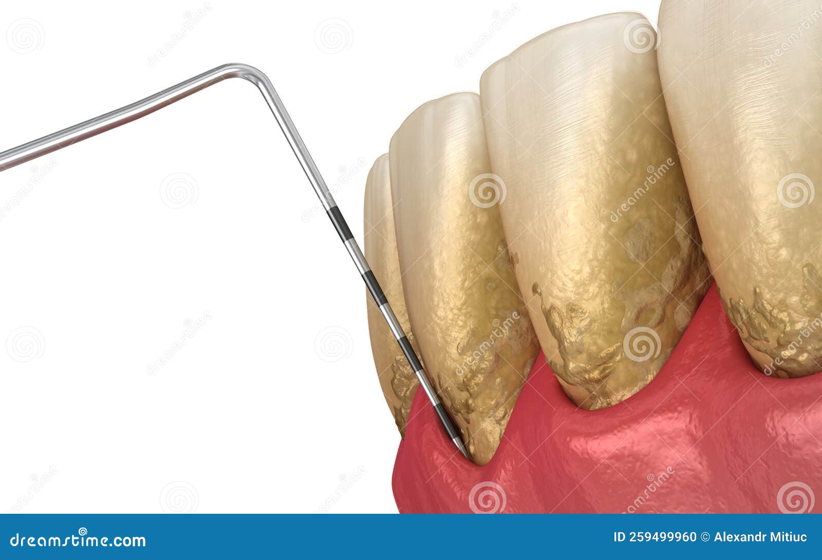 Periodontitis Testing, Gum Recession Process. Medically Accurate 3D ...