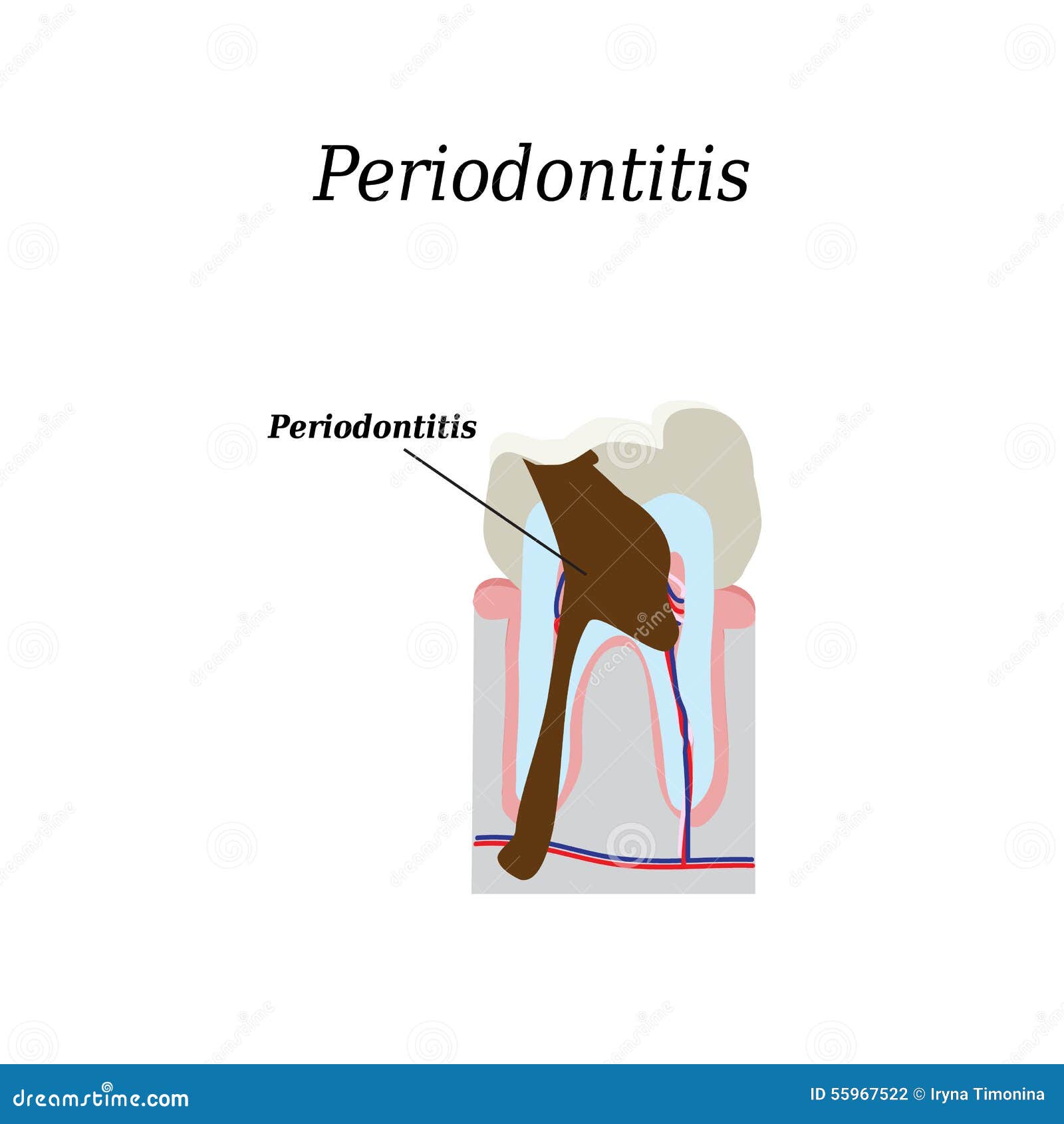 Periodontitis Vector Banner. Recession Gums Treatment. Stomatology ...