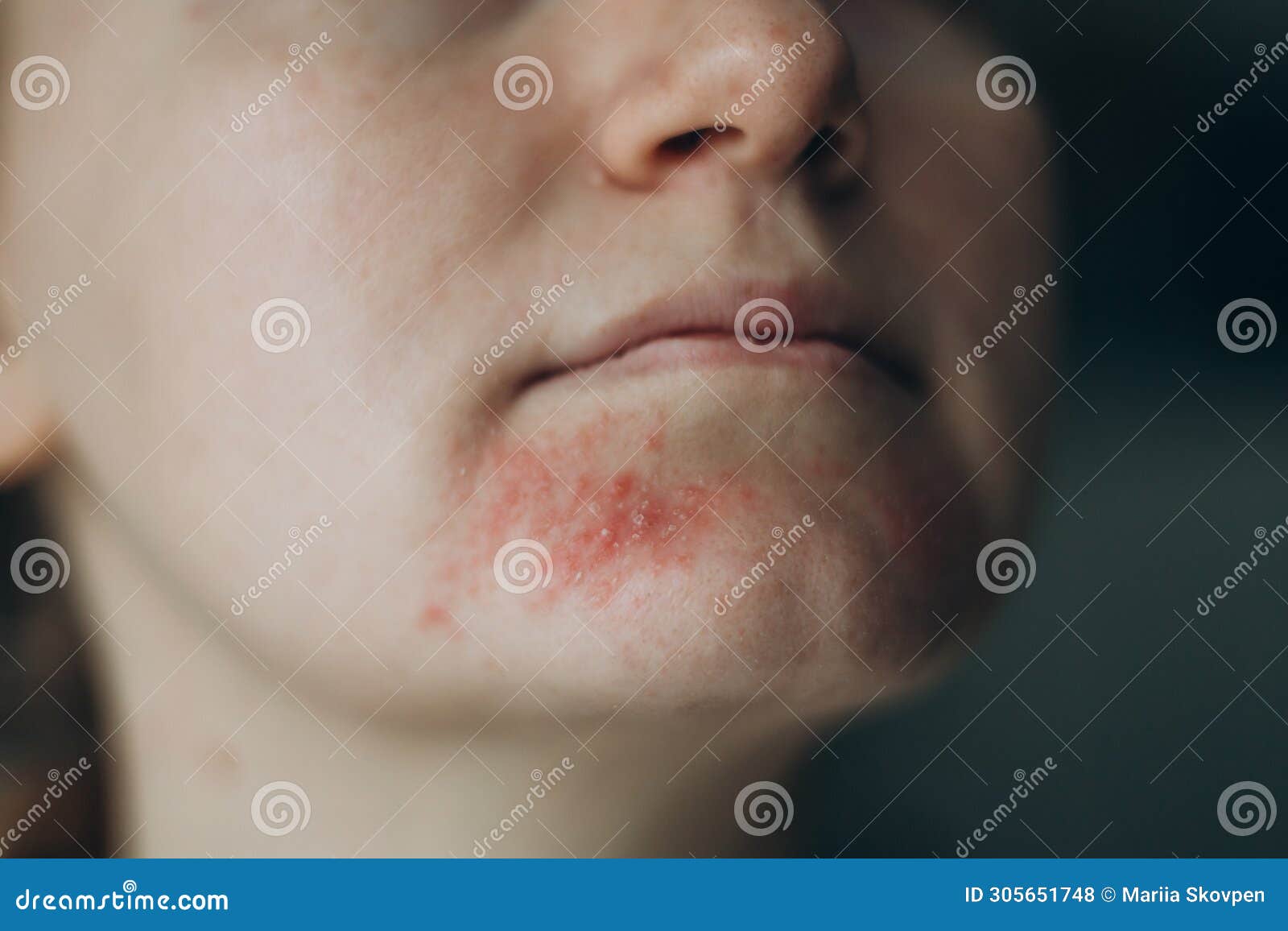 Perioral Dermatitis On Woman Face Closeup Dermatitis On Skin Ill