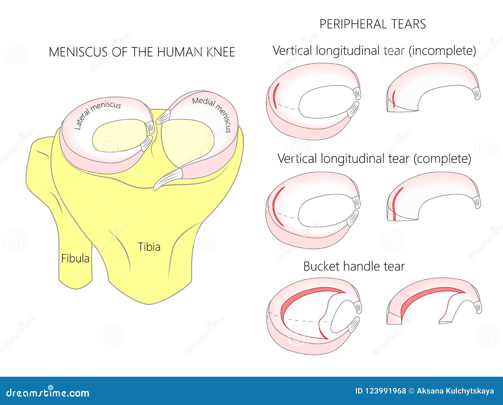 _Peripheral Risse Des Meniskus Vektor Abbildung - Illustration von ...