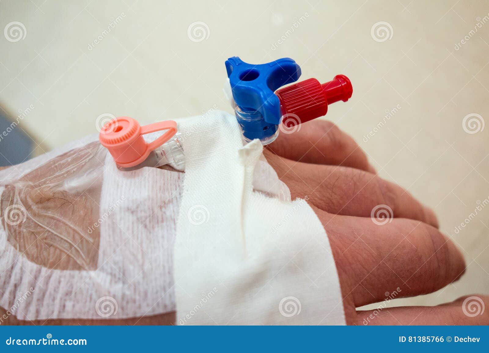 Peripheral Venous Catheter Venflon In Hand Stock Photography ...