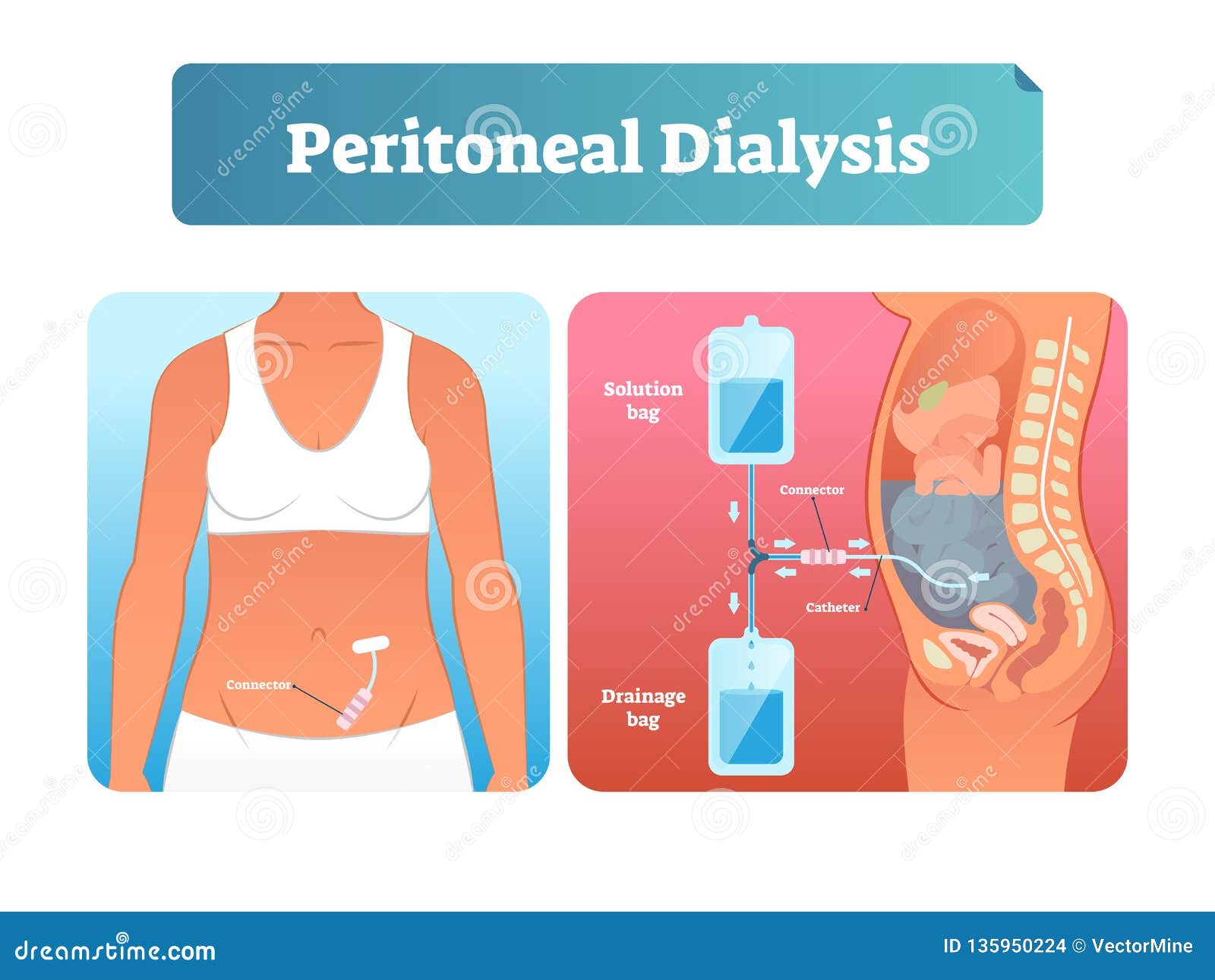 Dialysis Complete Information About Dialysis And Its
