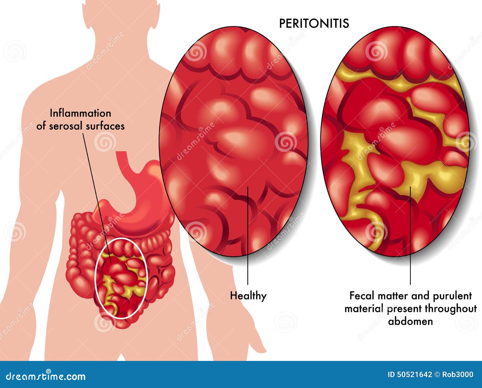 Peritonitis stock photo. Image of bacterial, secondary - 50521642