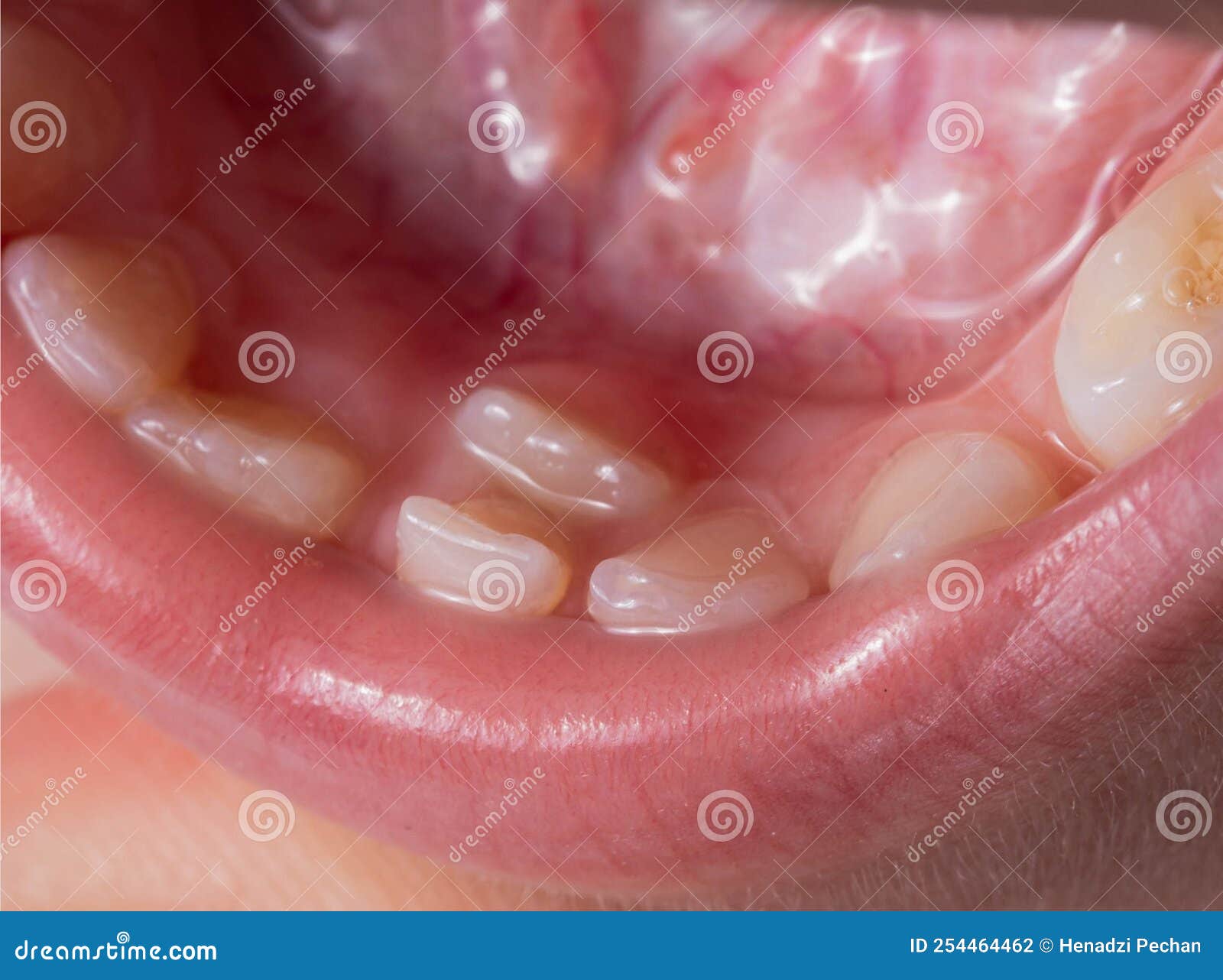 A Permanent Molar in a Child Grows Second Row. Incorrect Growth of ...