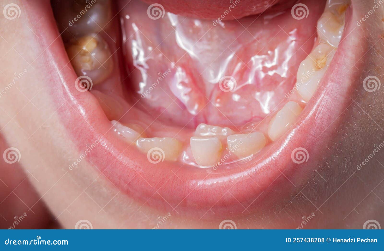 A Permanent Molar in a Child Grows Second Row. Incorrect Growth of ...