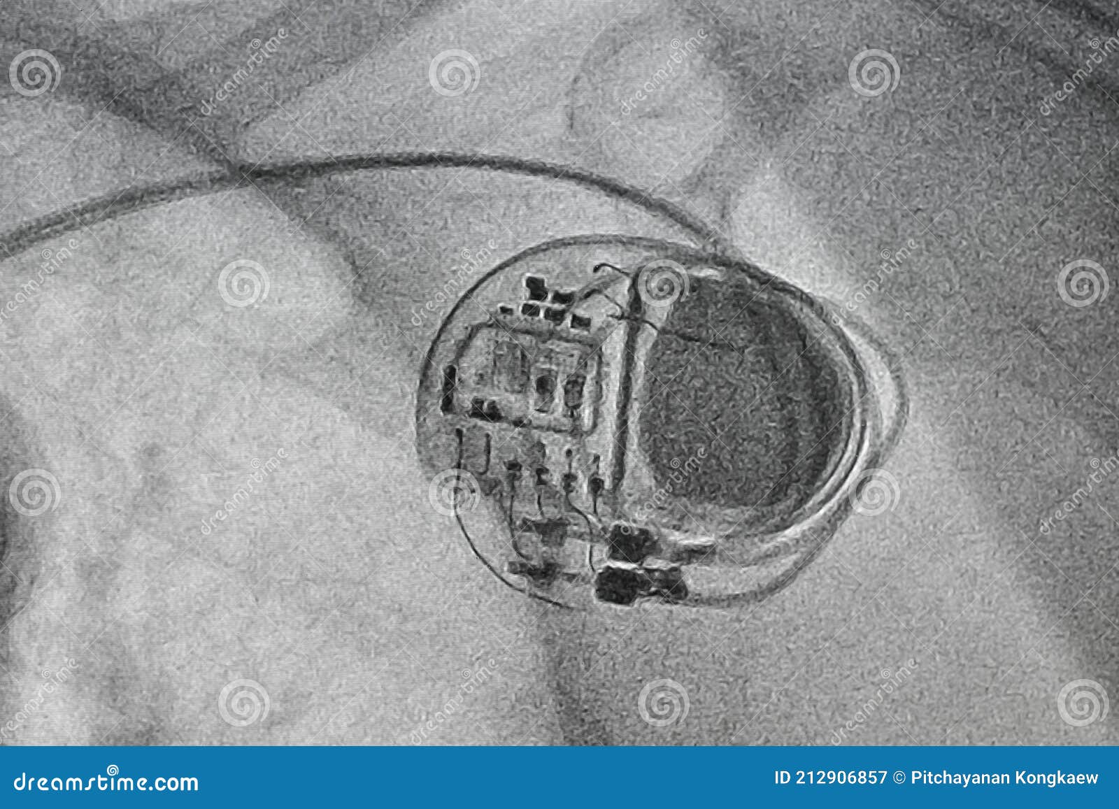 Permanent Pacemaker X-ray Image Stock Image - Image of life, hand ...
