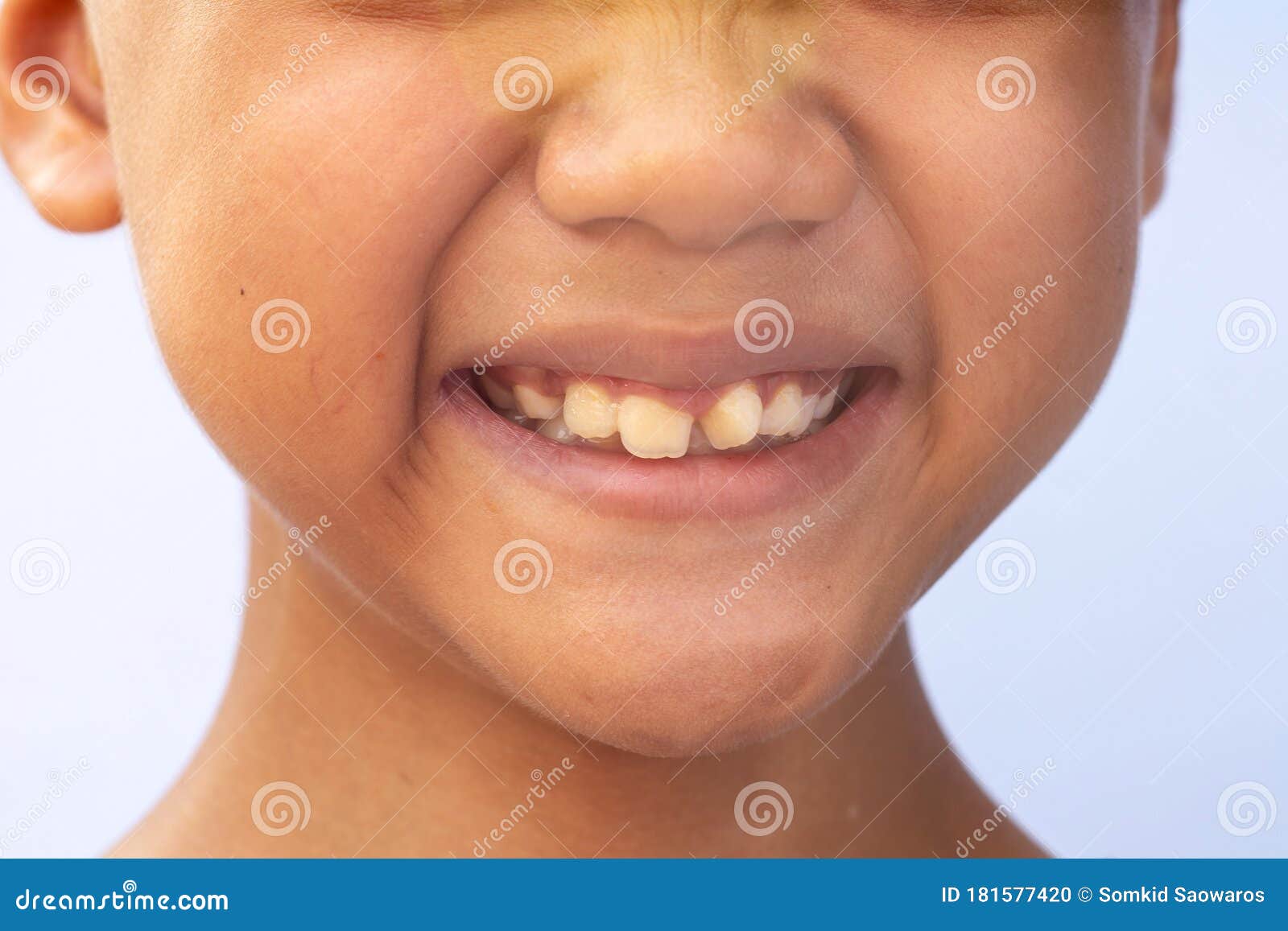 The Permanent Teeth in Front of Boys Aged 8 To 10 Years that are ...