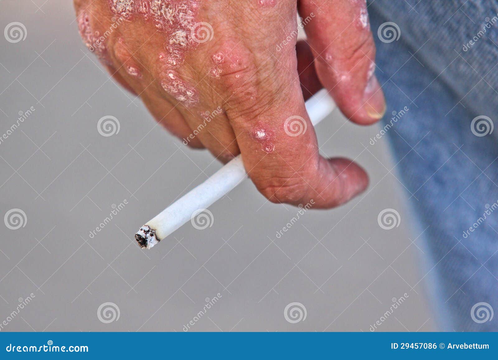 Person with Psoriasis, Smoking Stock Photo - Image of chronic ...