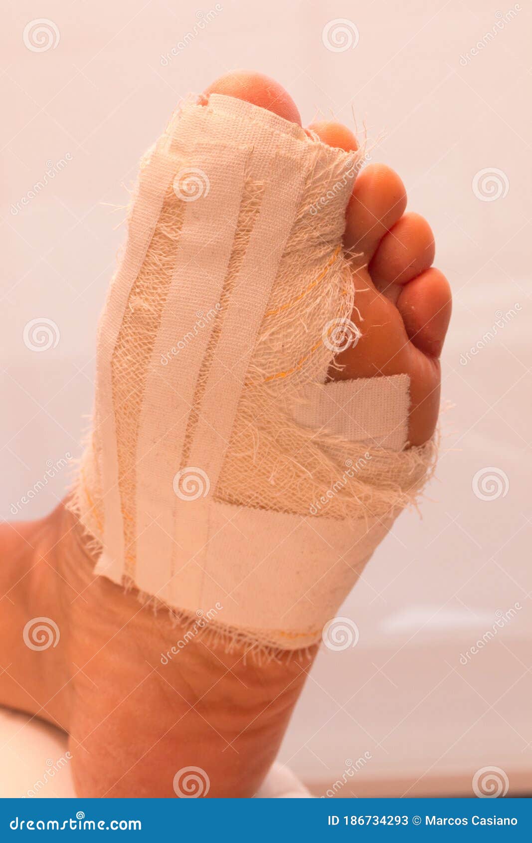 A Persons Bandaged Up Broken Big Toe Stock Image - Image of injured ...