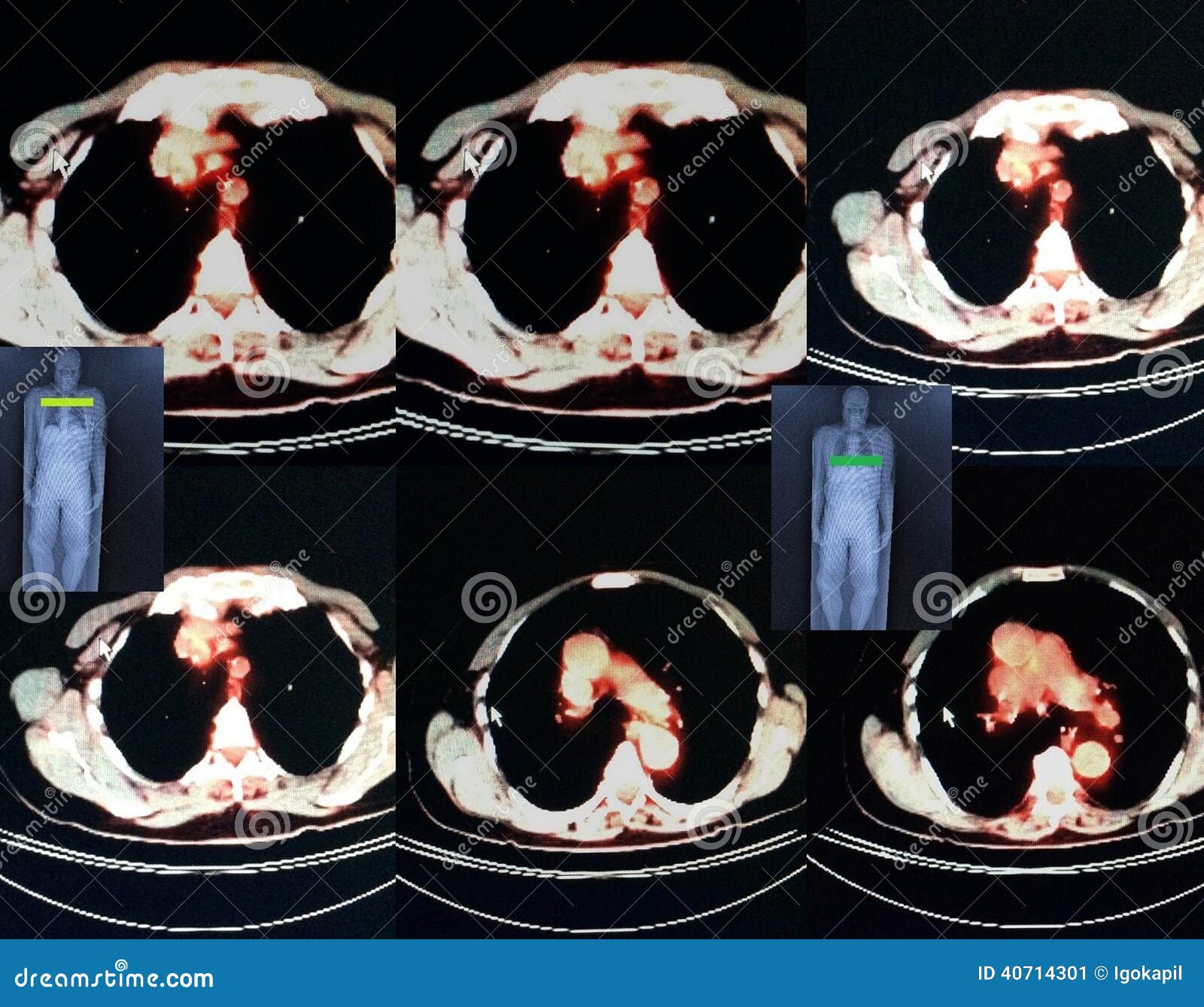 Pet/ct niveau van longen stock afbeelding. Image of film - 40714301