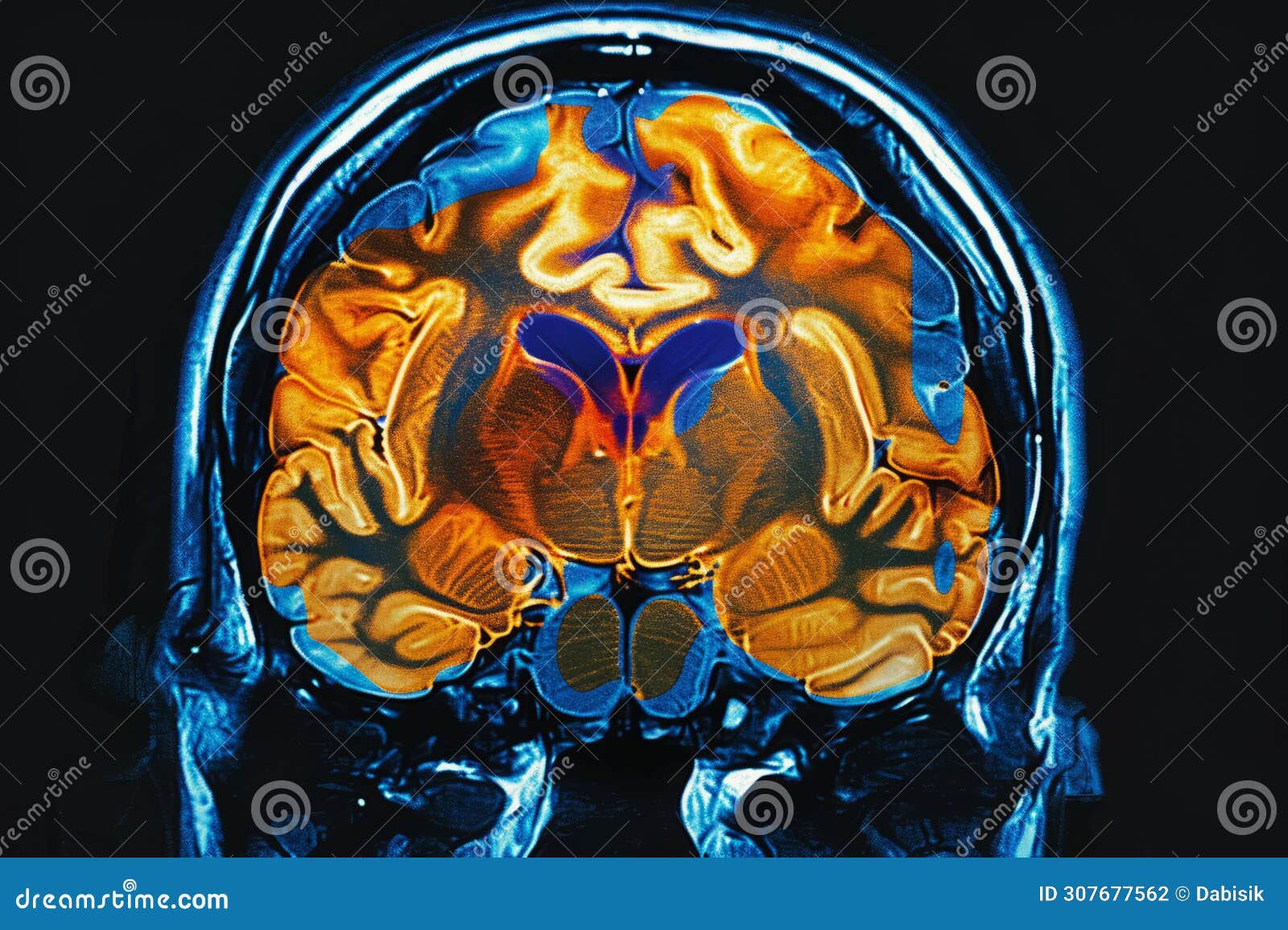 PET CT scan of human brain stock photo. Image of stroke - 307677562