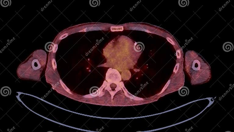 A PET-CT Scan Image is a Diagnostic Visualization Combining Positron ...