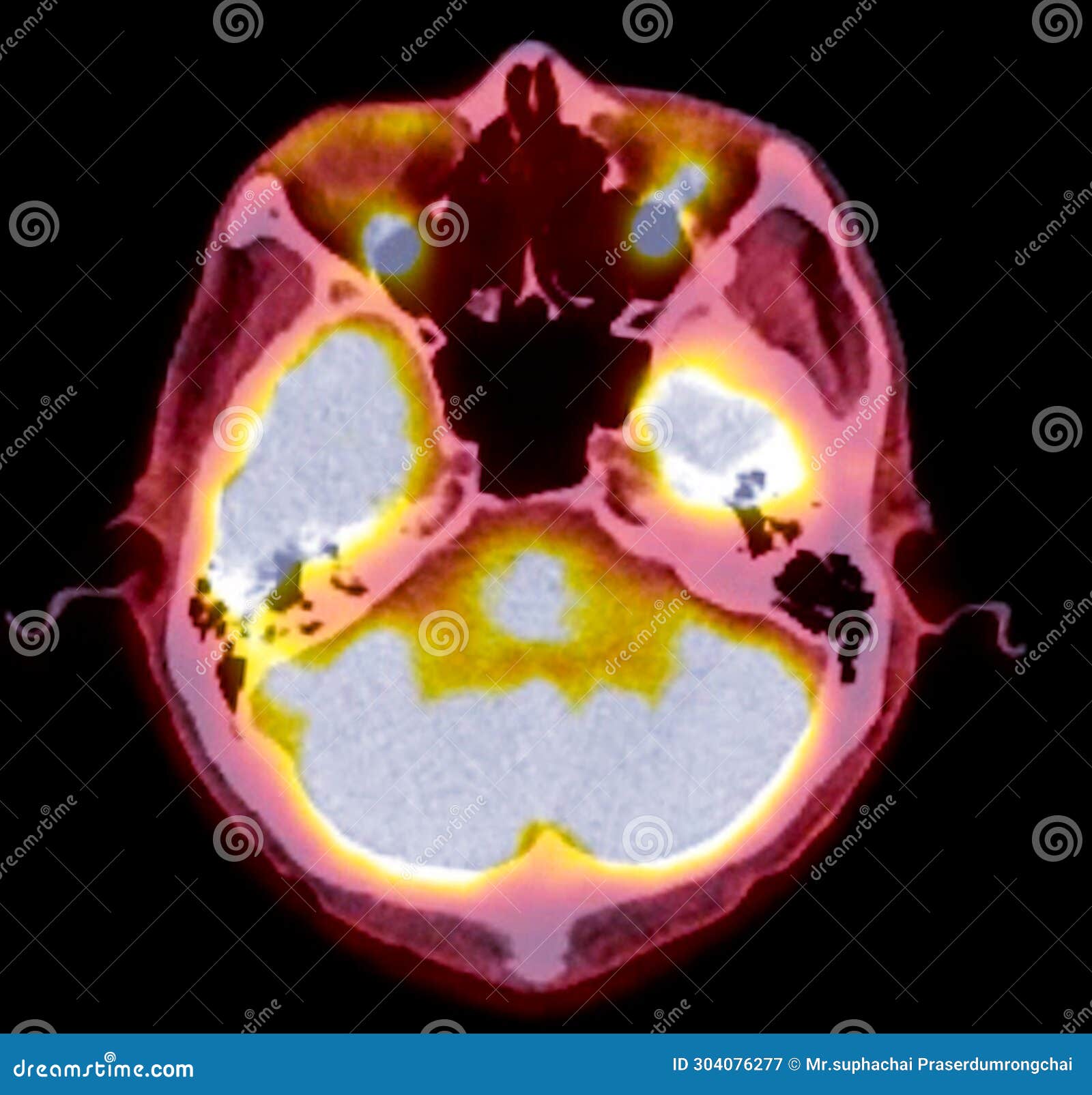 A PET-CT Scan Image is a Diagnostic Visualization Combining Positron ...