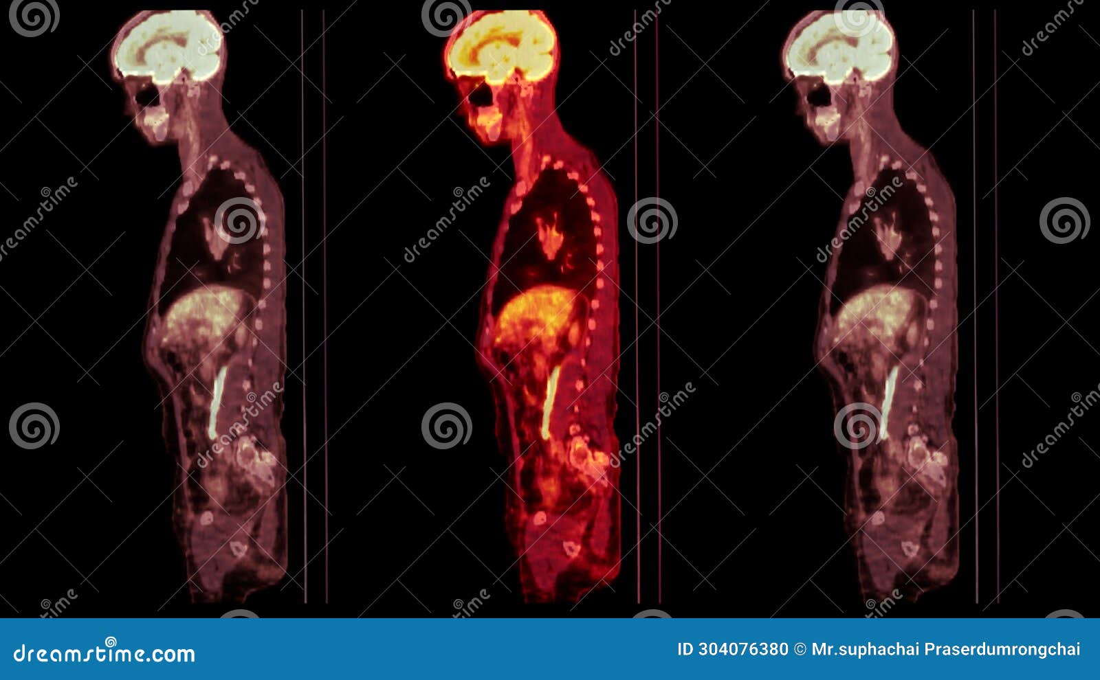 A PET-CT Scan Image is a Diagnostic Visualization Combining Positron ...
