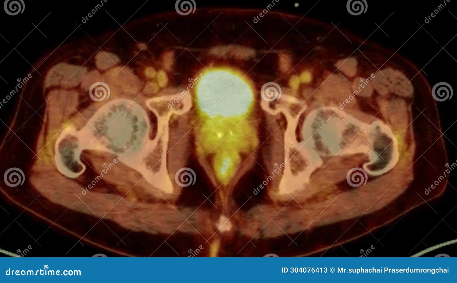 A PET-CT Scan Image is a Diagnostic Visualization Combining Positron ...
