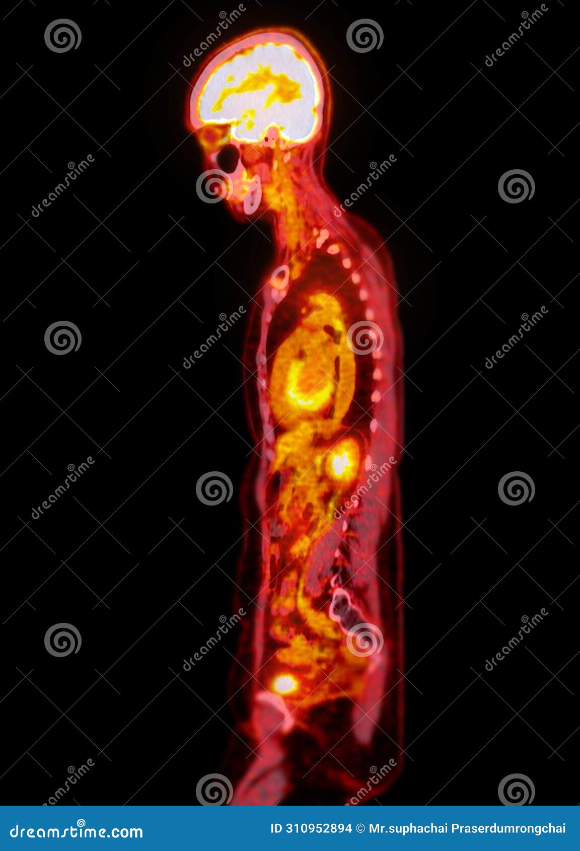 A PET-CT Scan Image is a Diagnostic Visualization Combining Positron ...