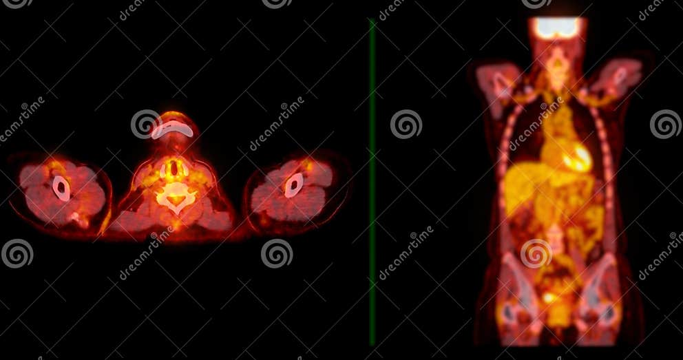 A PET-CT Scan Image is a Diagnostic Visualization Combining Positron ...