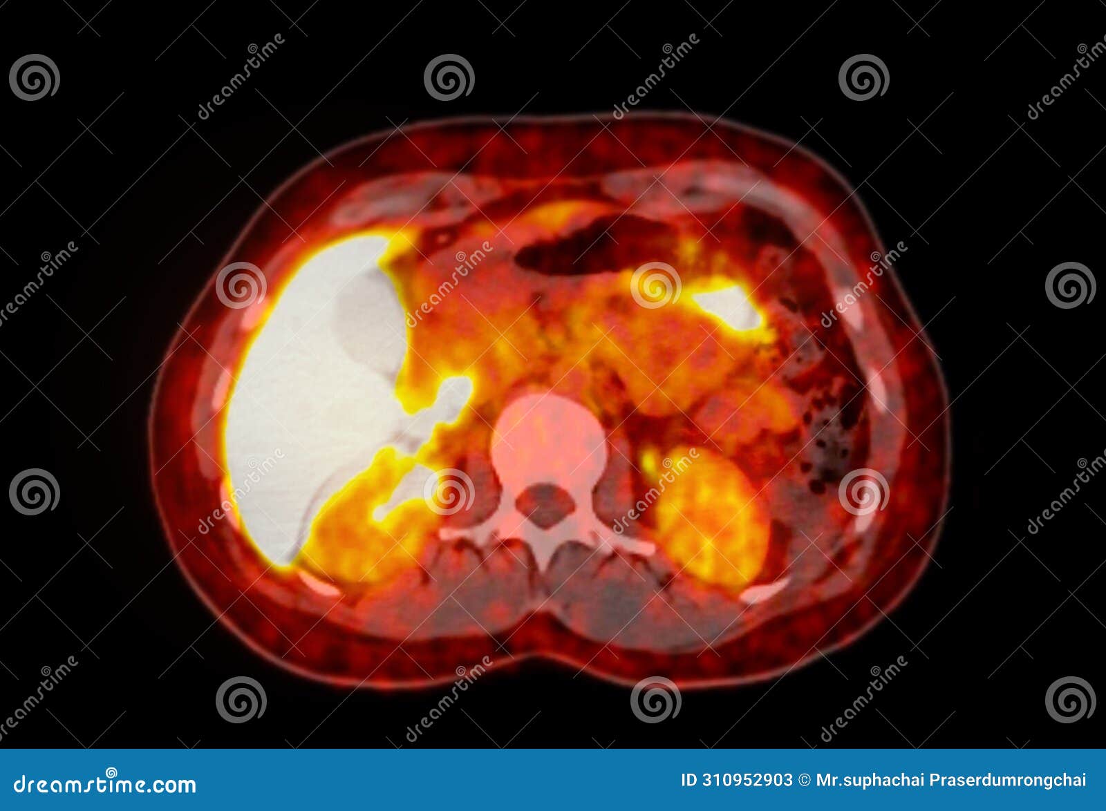 A PET-CT Scan Image is a Diagnostic Visualization Combining Positron ...