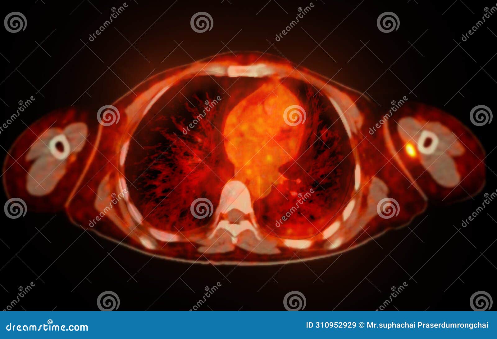 A PET-CT Scan Image is a Diagnostic Visualization Combining Positron ...