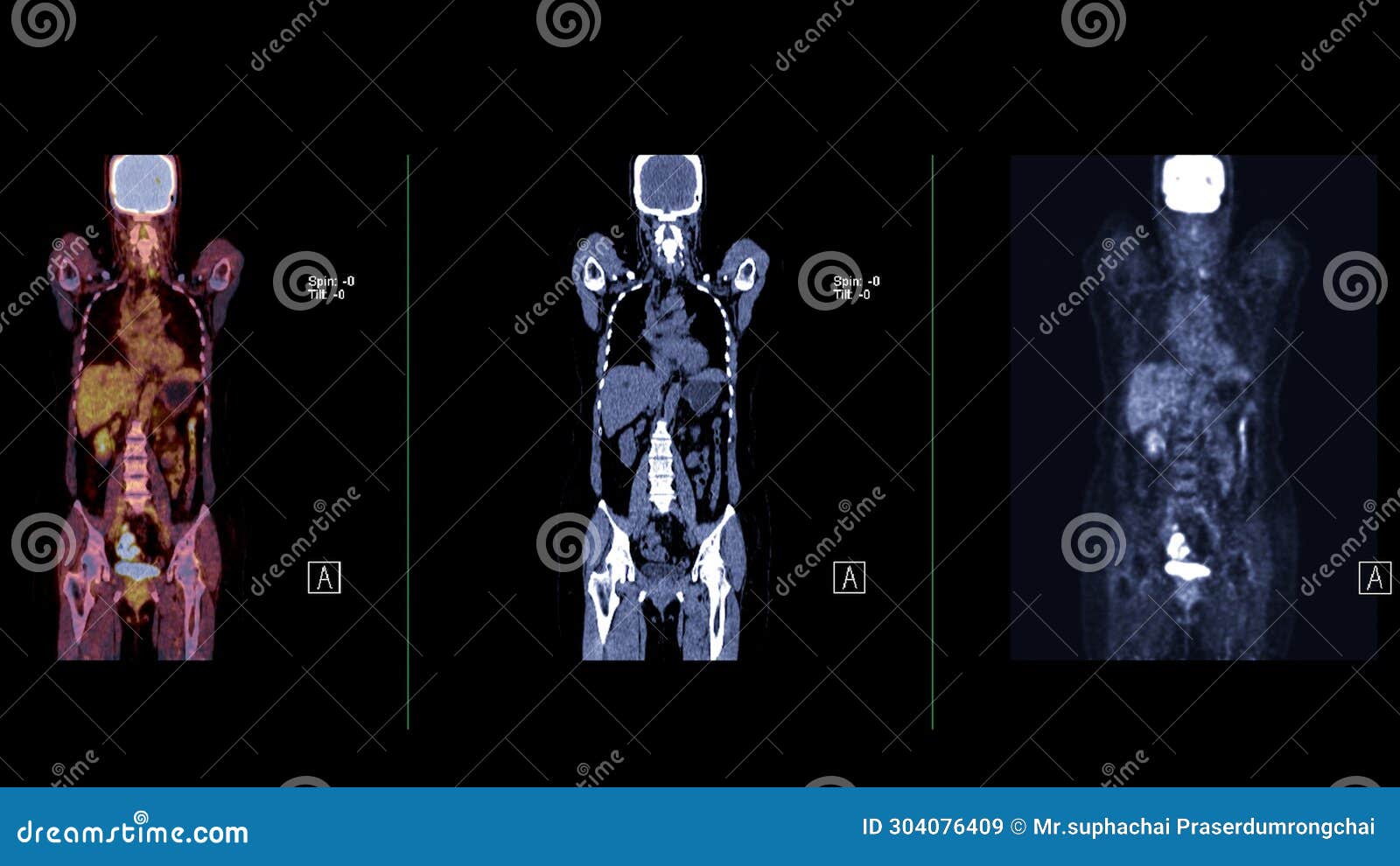 A PET-CT Scan Image is a Diagnostic Visualization Combining Positron ...