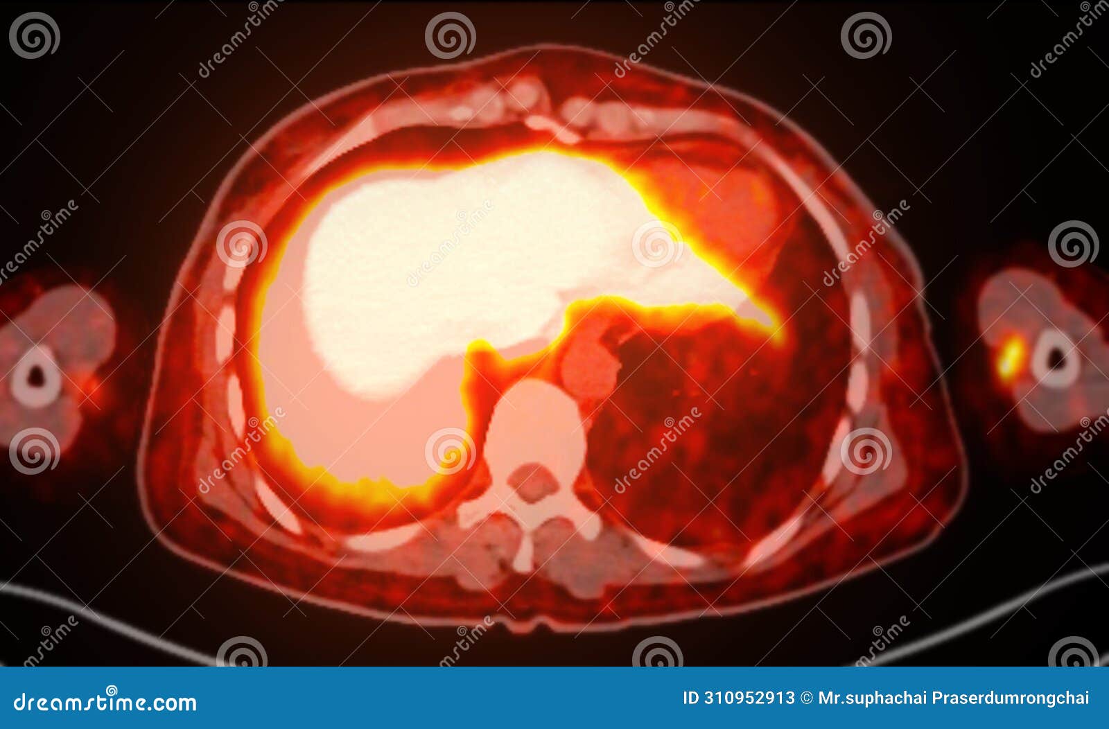 PET - Positron Emission Tomography Acronym With Marker, Medical Concept ...